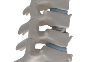 Cervical Disc Replacement Surgery - NAVALADI SPINE & KNEE CLINIC